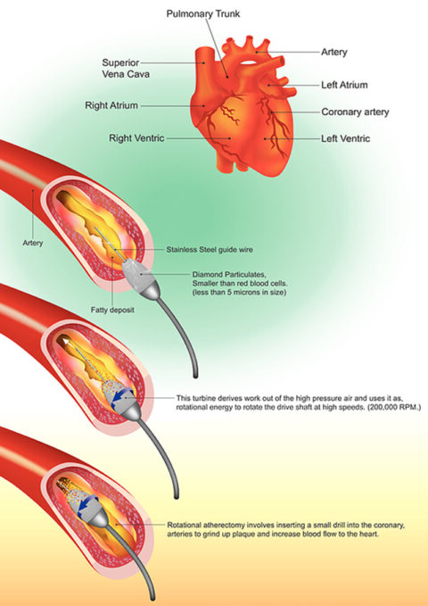 Rotational Atherectomy | American Heart Center PC