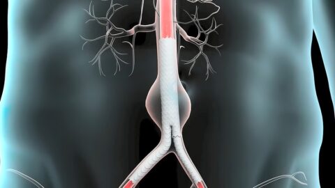 Abdominal Aortic Aneurysms | American Heart Center PC
